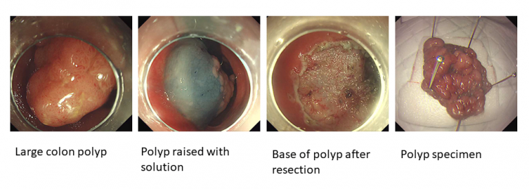 Advanced Endoscopic Polypectomy at Crest Surgical Practice